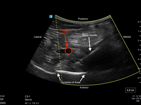 How to Perform an IPACK Block with Ultrasound | FUJIFILM Sonosite